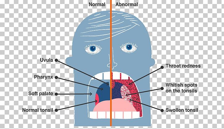 Streptococcal Pharyngitis Sore Throat Streptococcus PNG, Clipart, Ache ...